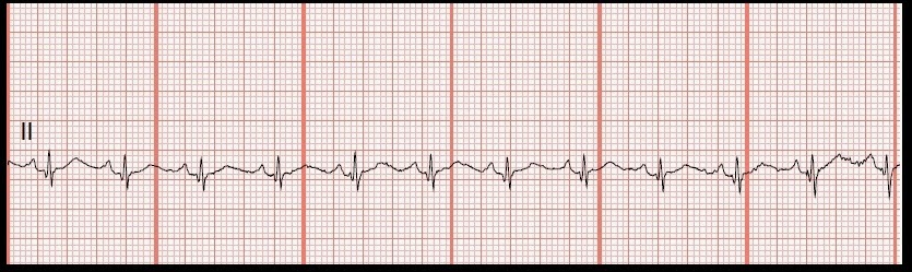 EKG Rhythm Quiz 235