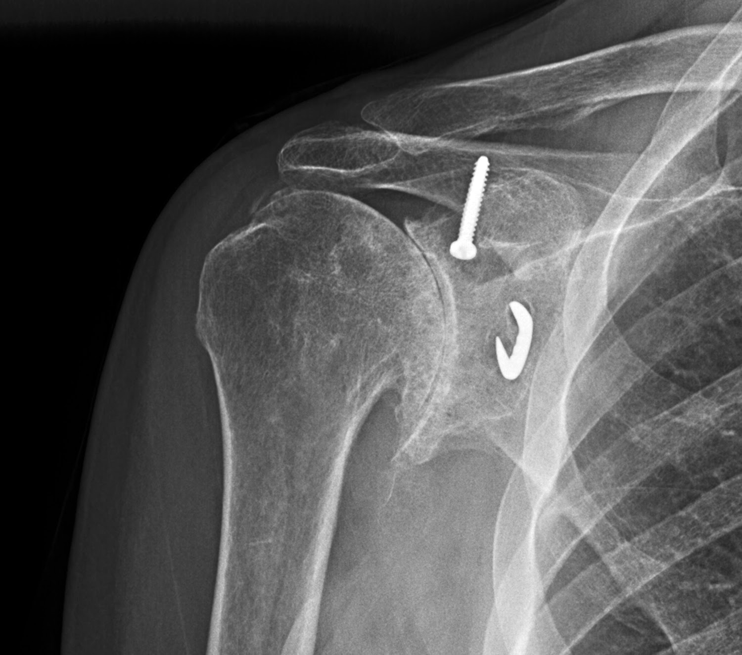 UW Shoulder and Elbow Academy: Shoulder joint replacement - many ...