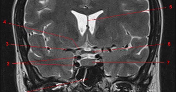 INRA: Sindrome de la silla turca y la importancia de la RMN