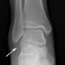 RiT radiology: Fracture of the Lateral Process of Talus