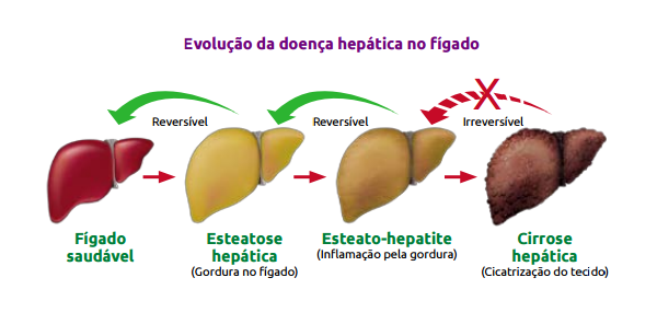 Atlas virtual de histologia e patologia: [CC #7]: ESTEATOSE HEPÁTICA