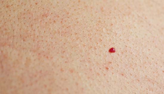 Muncul Bintik Merah di Kulit, Berbahayakah? - Artikel Munthe - Artikel ...