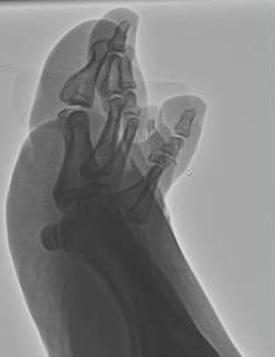 Lesser Toe Fracture-Plain Xray - Sumer's Radiology Blog