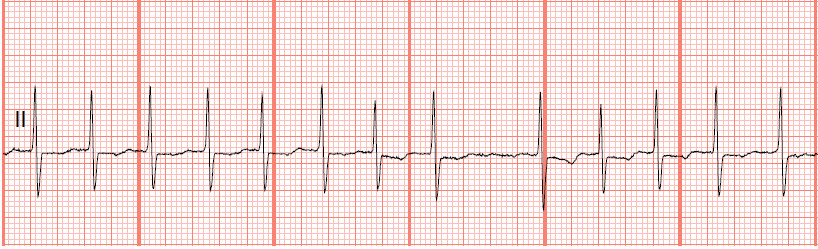 Refractory atrial flutter icd 10 - llckiza
