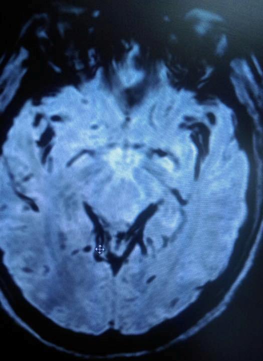 Brain death For Radiologist - Radiology Imaging