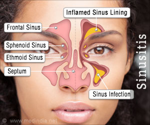 Cara Mengobati Sinusitis Tanpa Operasi ~ Gejala Pantangan dan Penyebab