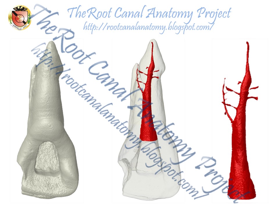 The Root Canal Anatomy Project: Two-Rooted Maxillary Central Incisor