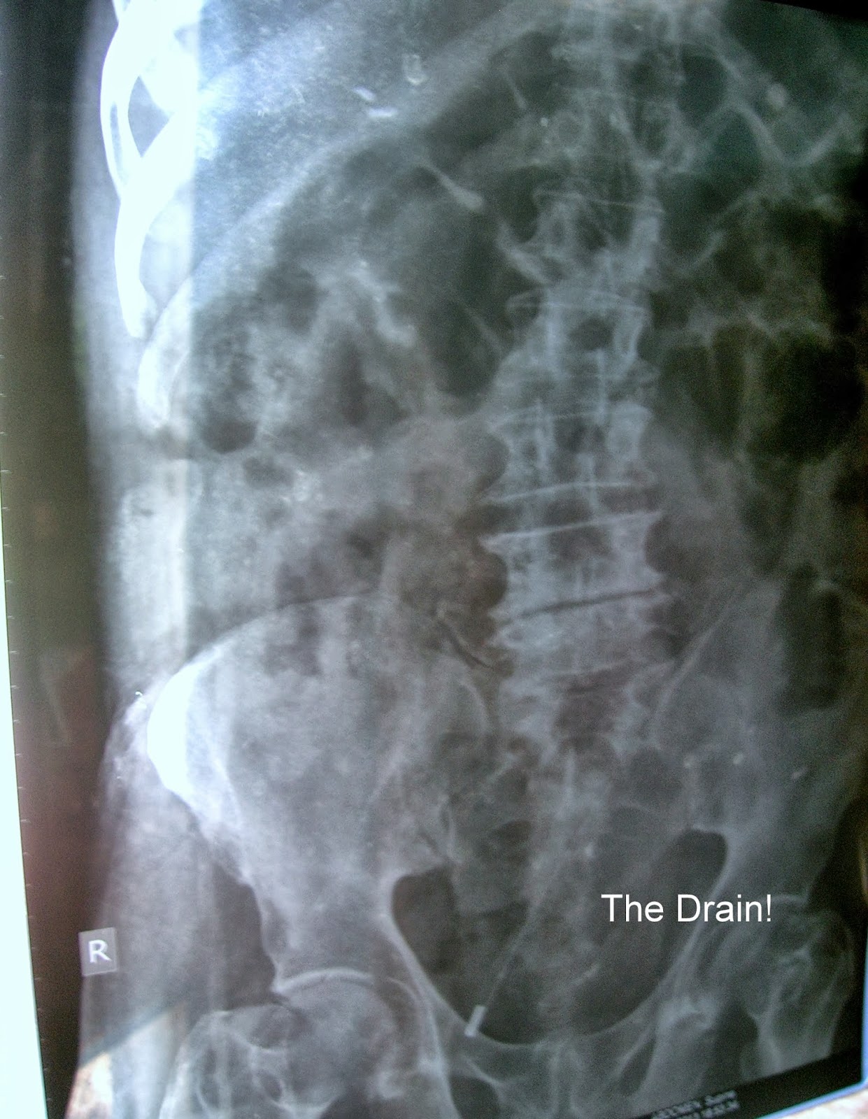 Techknowdoc's Surgical Adventures!: September 2013