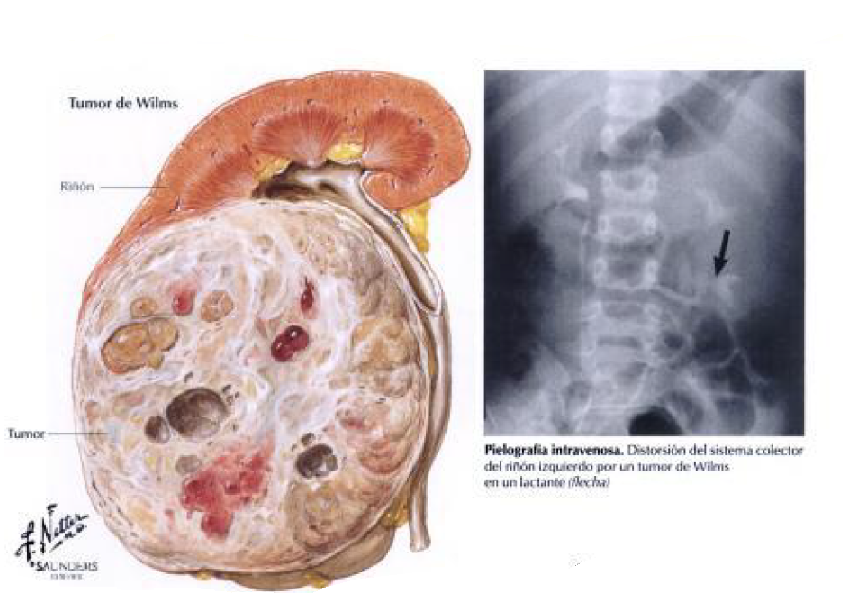 Enfermedades crónicas: TUMOR DE WILMS