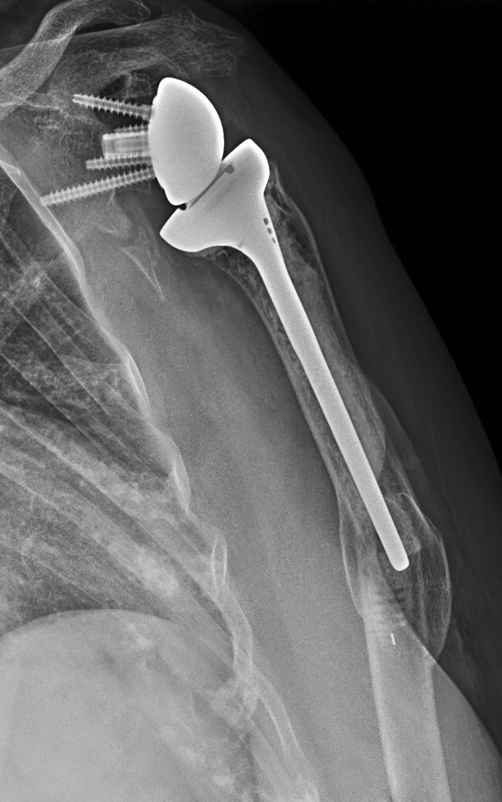 UW Shoulder and Elbow Academy: Reverse total shoulder joint replacement ...