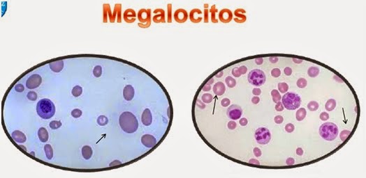 Fichero de Hematología: Anormalidades Eritrositarias.