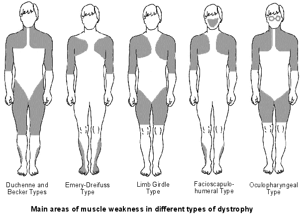COCHIN CARDIAC CLUB: MUSCULAR DYSTROPHY (MD)