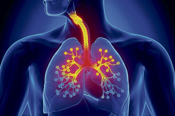 What Is Bronchitis? - Teroes
