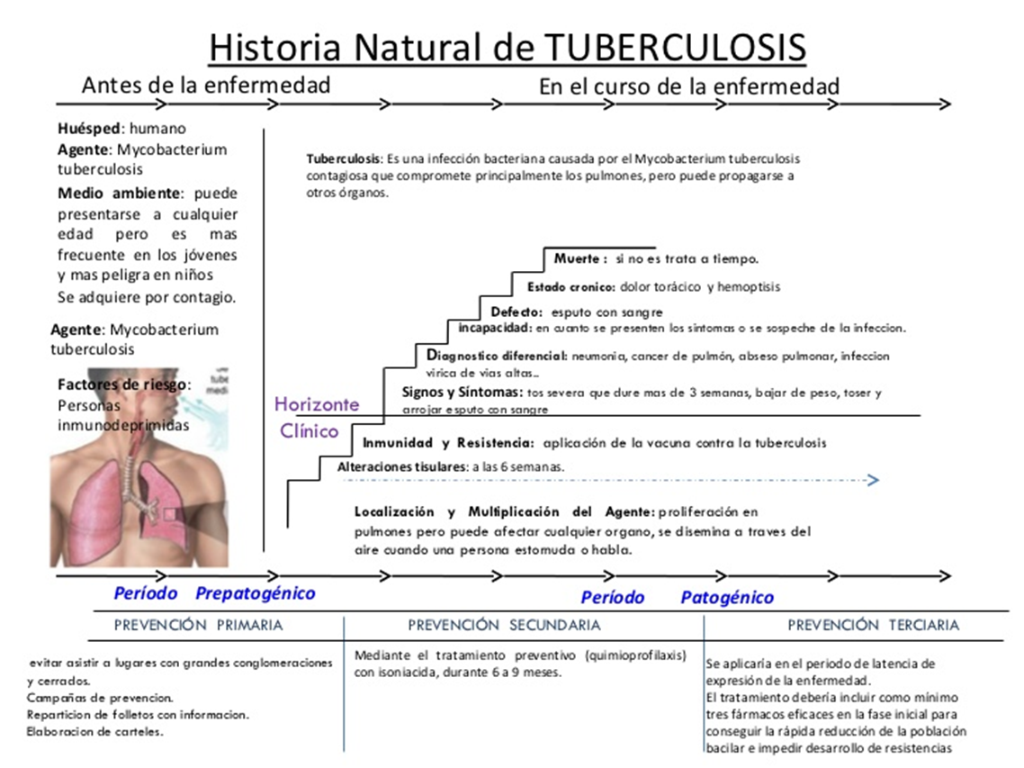 Tuberculosis Pulmonar