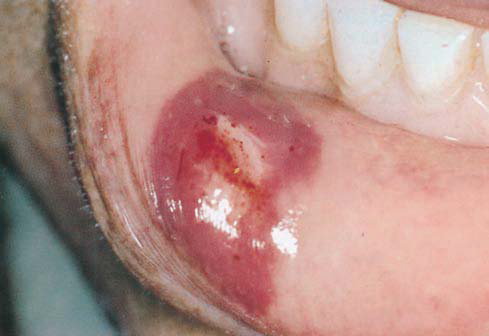 Dentistry and Medicine: Red Lesions of the Oral Mucosa-Differential ...