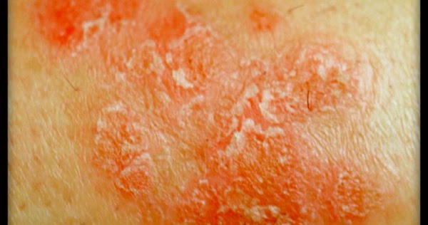 Les maladies de la peau et probleme de peau - Quand le teint reflète ...