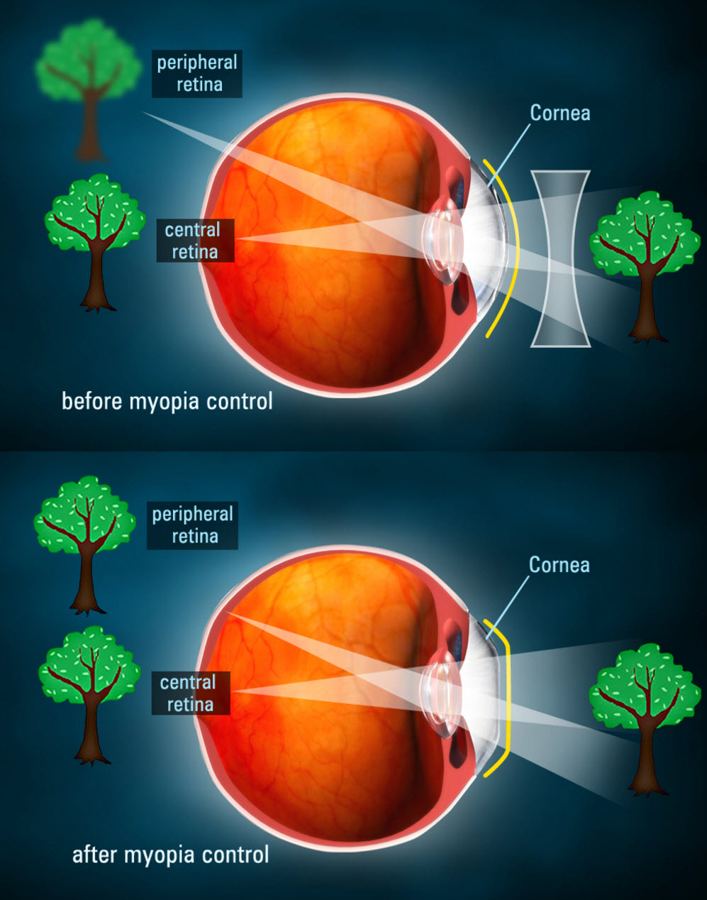 What is Orthokeratology?