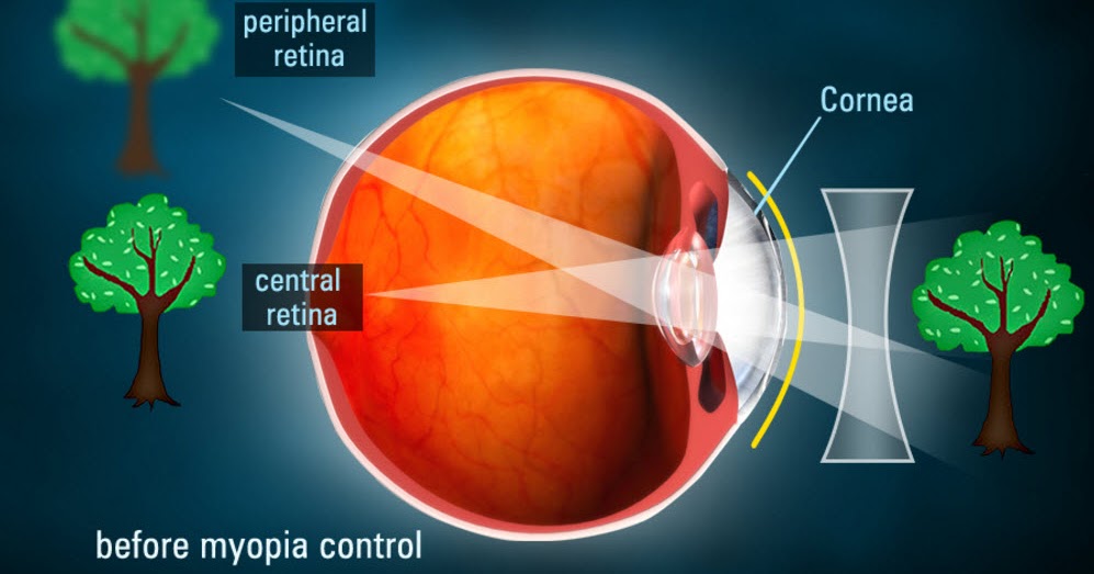 What is Orthokeratology?