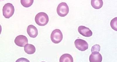 Blog del Laboratorio clinico : Dianocitos o células en diana ...