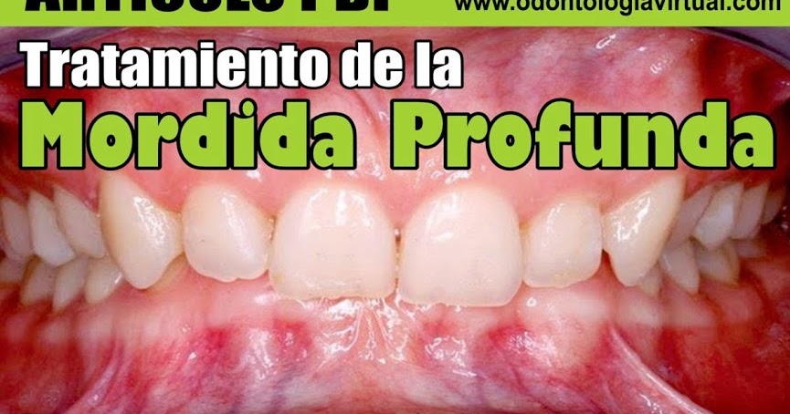MORDIDA PROFUNDA: Tratamiento y Caso Clínico - Ovi Dental