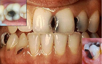 Faktor yang Mempengaruhi Terjadinya Karies Gigi - Education Articles