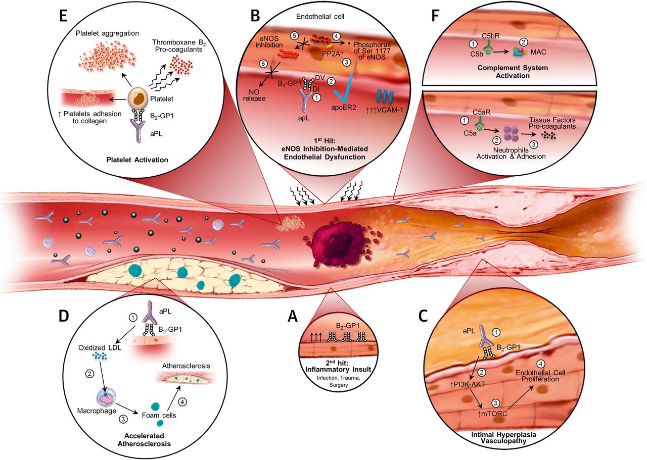 What Is Antiphospholipid Syndrome? - Teroes