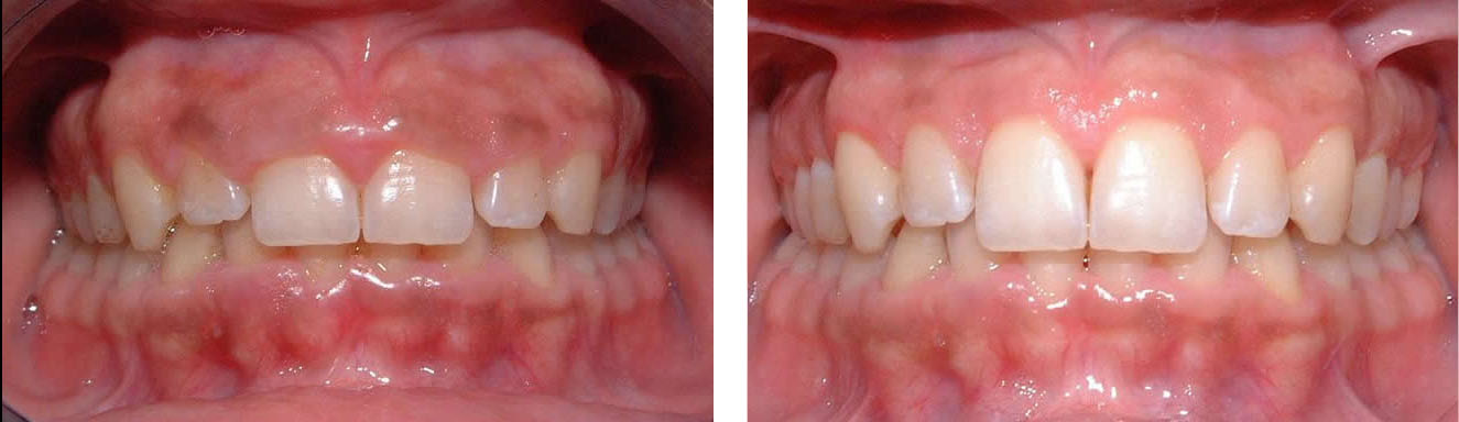 Dr. Ivan Caso: ¿Qué es una Gingivectomía y para qué sirve?