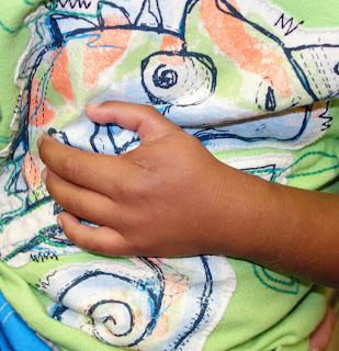 Even More Thoughts on Pollicization | Congenital Hand and Arm ...