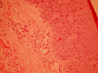 VIRTUAL GRAND ROUNDS IN DERMATOLOGY 2.0: Psoriasis vs. PRP: Your Thoughts