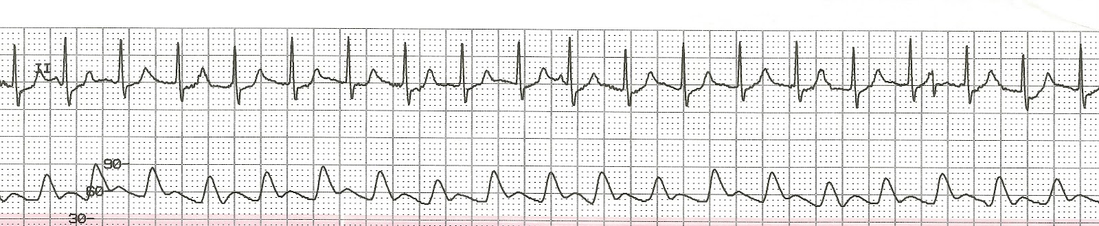 EKG Rhythm Strips of Unstable SVT with Arterial Blood Pressure Waveform