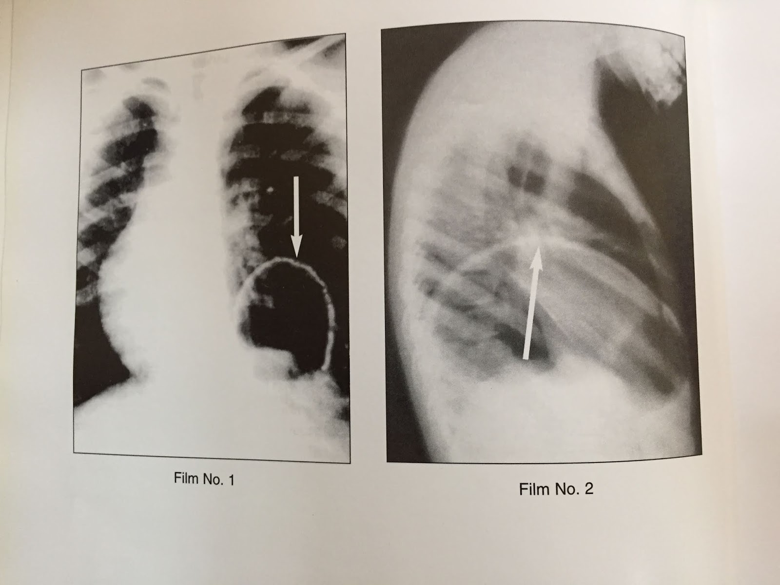 XRAYS OF EVENTRATION