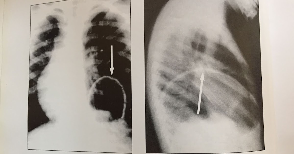 XRAYS OF EVENTRATION