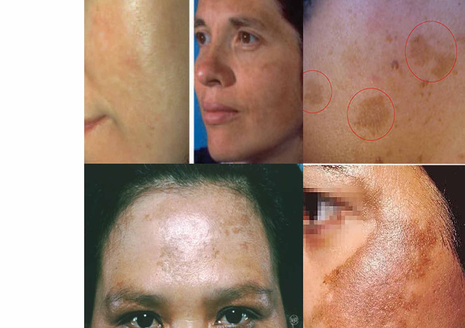 Skin and Health Care: Melasma