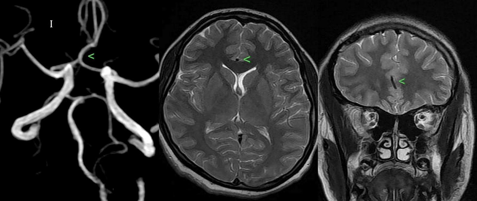 Dr Balaji Anvekar FRCR: Azygos ACA