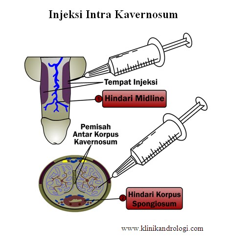 Klinik Andrologi: Maret 2012