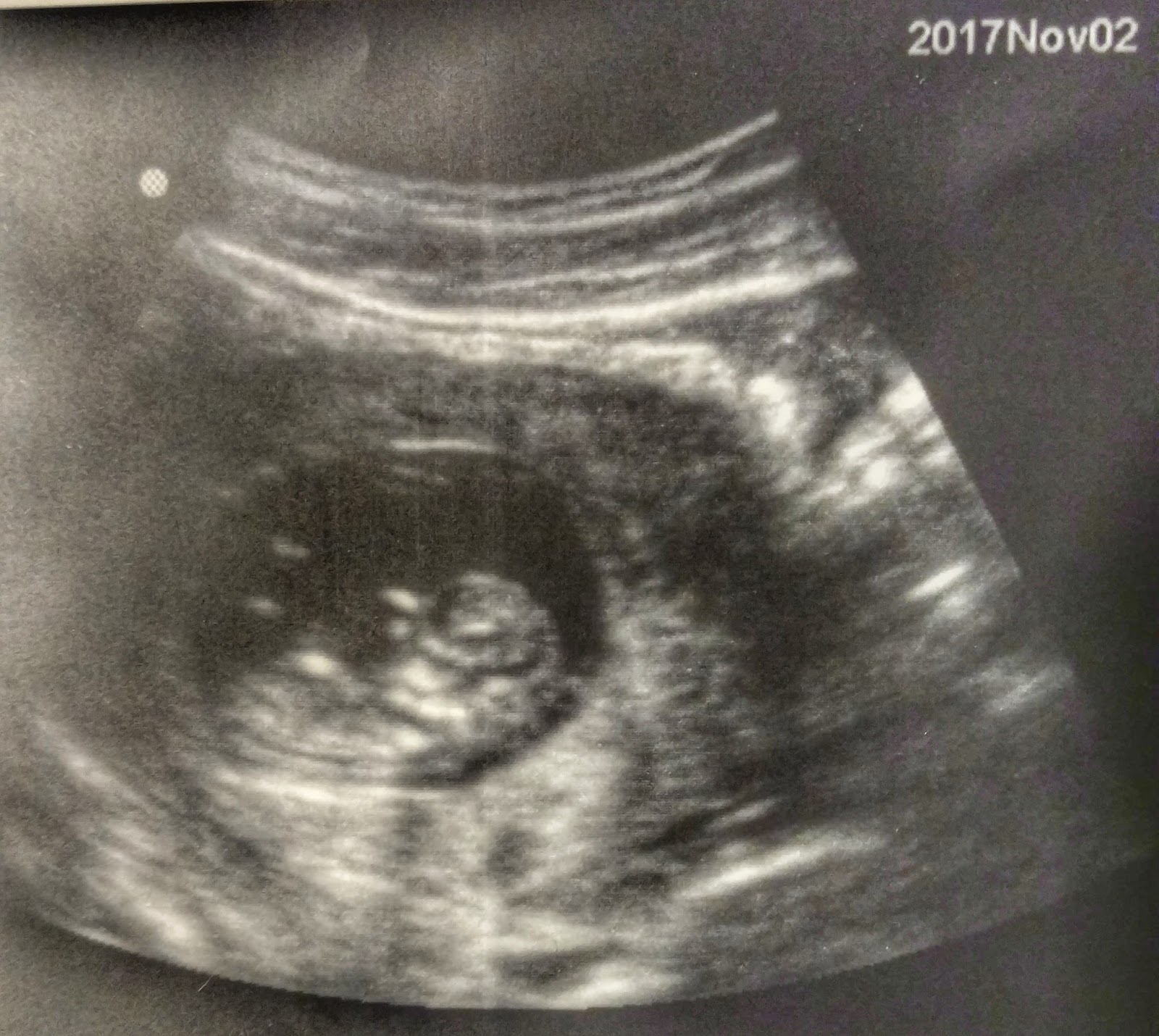 Zulekha Williams 12 Weeks Vs 15 Weeks Pregnant Zulekha Williams 12 Weeks Vs 15 Weeks Pregnant