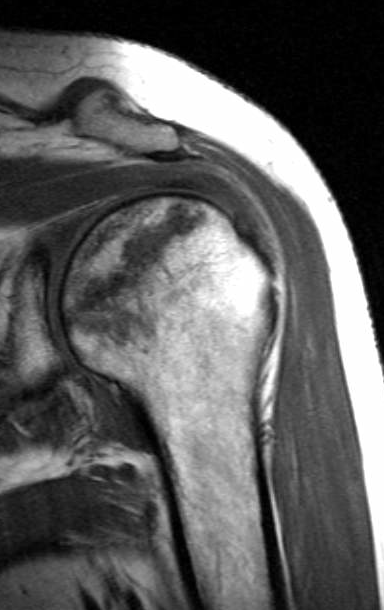 UW Shoulder and Elbow Academy: Bilateral avascular necrosis after ...