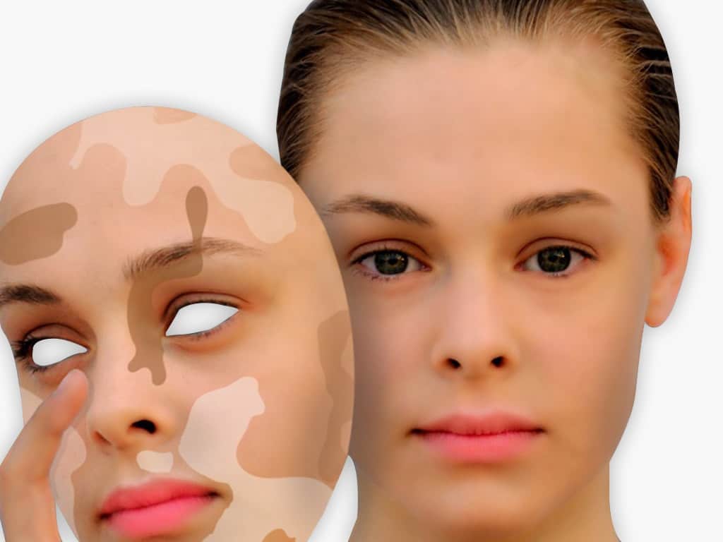 How Vitiligo Affects An Individual Life?: Marriage and White Patches ...