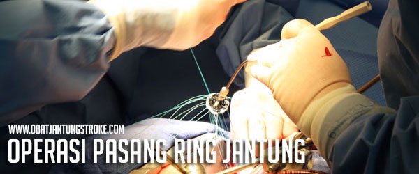 Edelwis Tiara P.M: Operasi Ring Jantung ''edelwis''