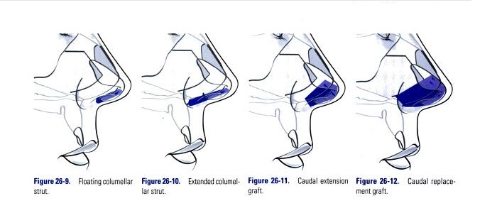 Nose Revision Surgery and Surgeons: The mystery of all the different ...