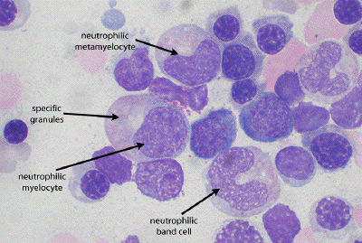 neutrophilic metamyelocyte,neutrophilic myelocyte,neutrophilic band ...