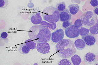 neutrophilic metamyelocyte,neutrophilic myelocyte,neutrophilic band ...