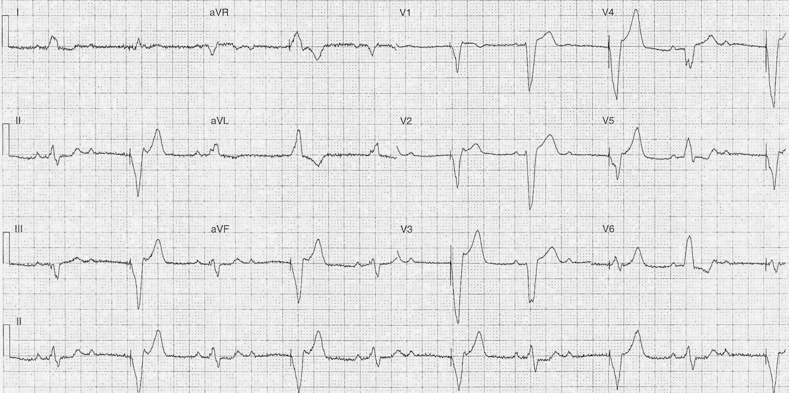 ECG of the Week: ECG of the Week - 14th January 2013 - Interpretation