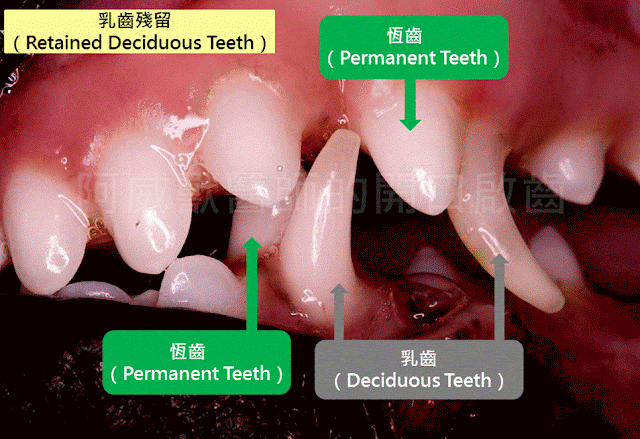 口腔疾病簡介—乳齒殘留（Retained Deciduous Teeth）