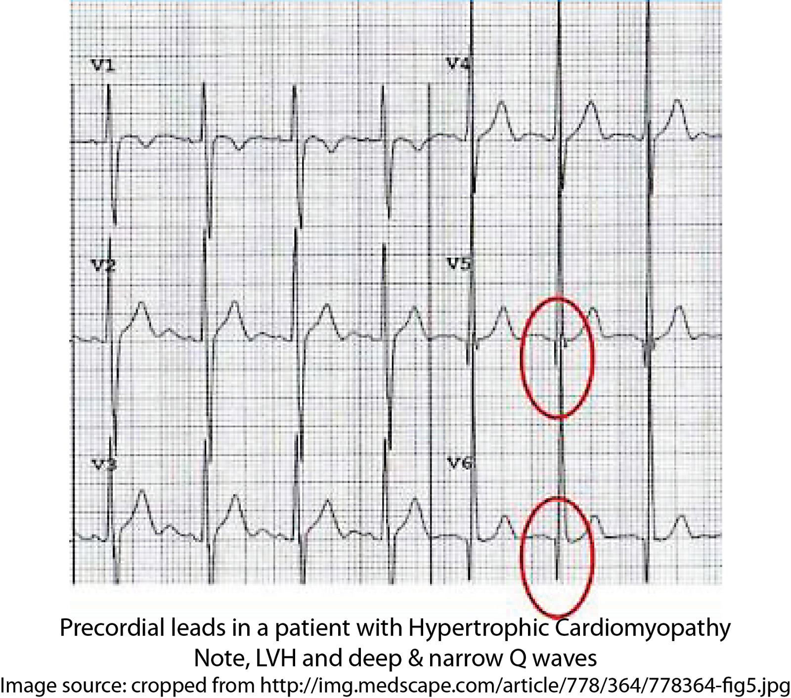 Everyday E(B)M: EKG Challenge #4 Case Conclusion: In Syncope, You Can't ...