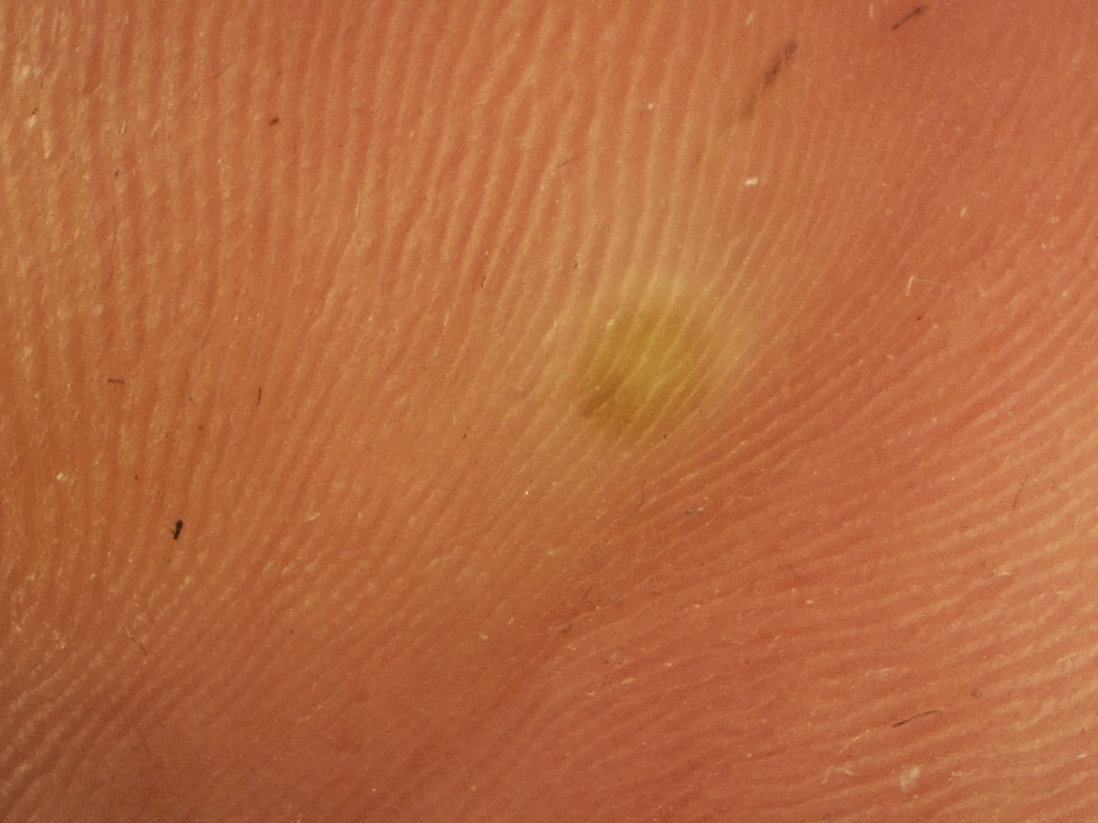 Podo Basas al Día: Pelos clavados en la planta del pie. K.Láser y ...