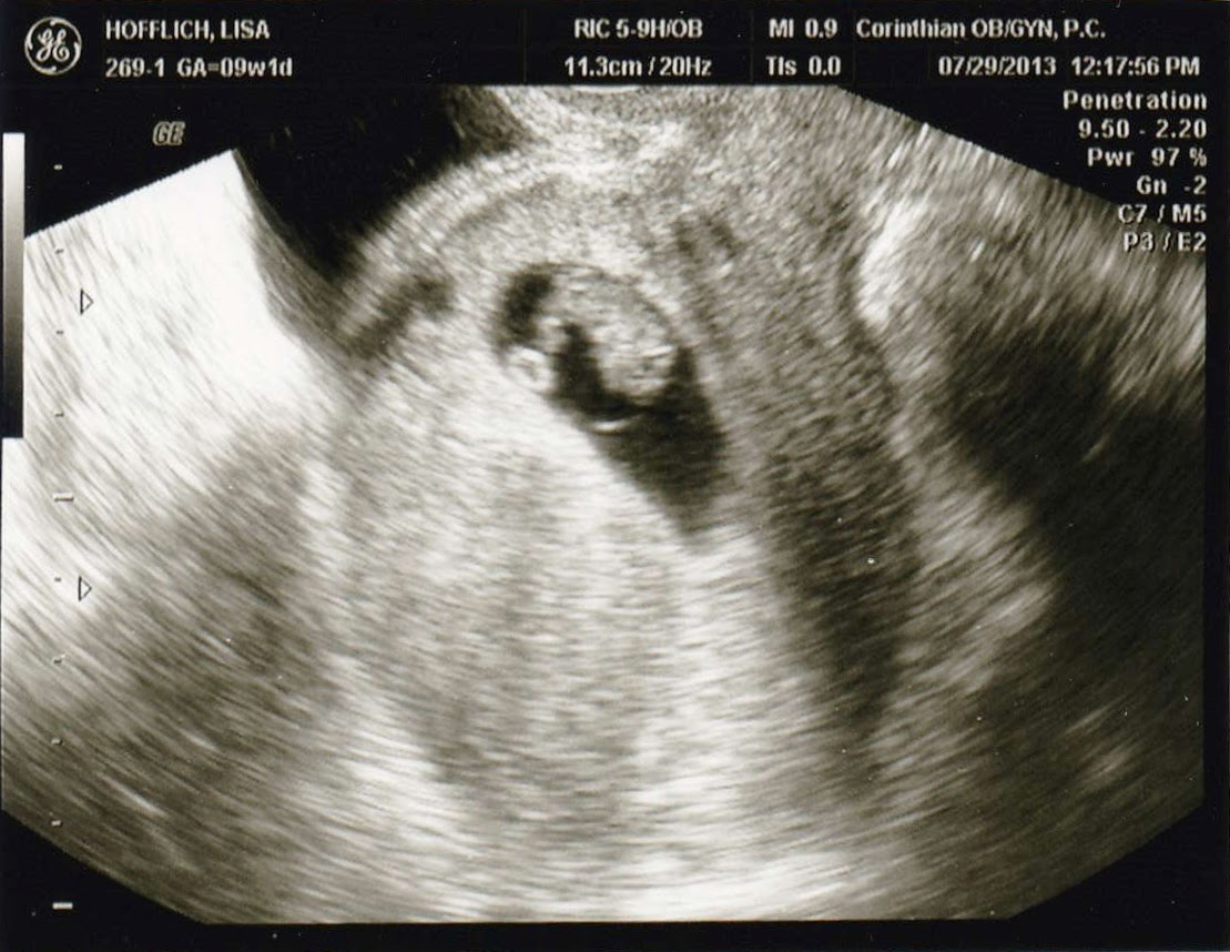 Hope Floats: My Journey Through Placenta Accreta/Percreta: My Pregnancy ...