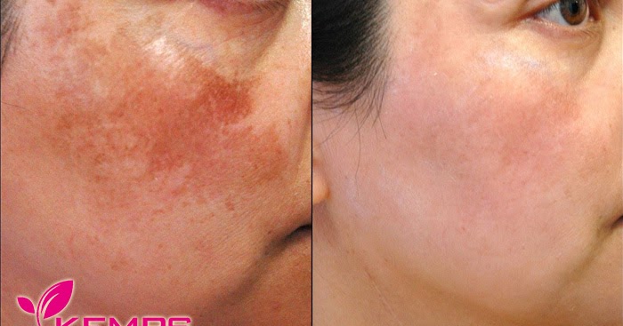 What is skin pigmentation on the face? And it’s treatment | KEMPS Skin ...