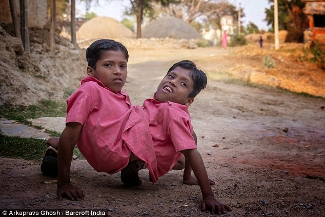 Gemelos siameses nos dan un ejemplo de vida y superación - Seamos Mas ...