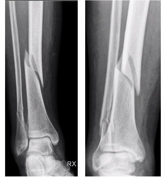 Blogão de Fisio: FRATURAS DO MEMBRO INFERIOR